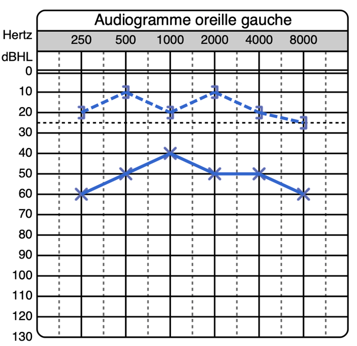 Guide complet pour comprendre les audiogrammes | Perte Auditive